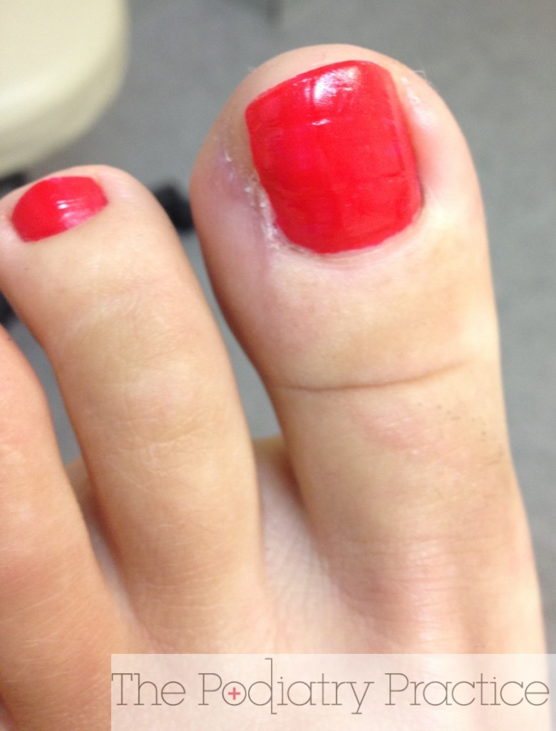 Wow, this is a severe ingrown toenail! – Podiatrist Brisbane Southside ...